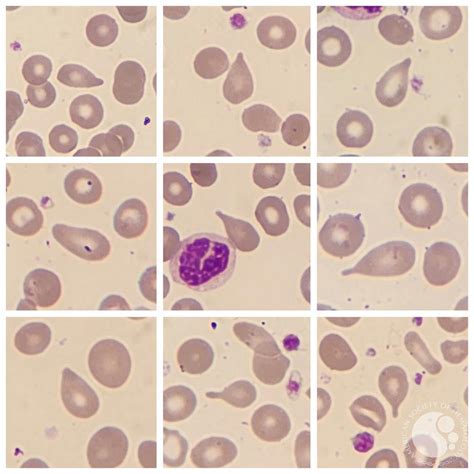 Myelofibrosis Teardrop Cells