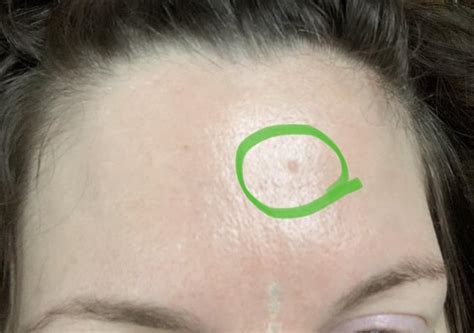 Bump On Forehead Could It Be Basal Call Carcinoma R