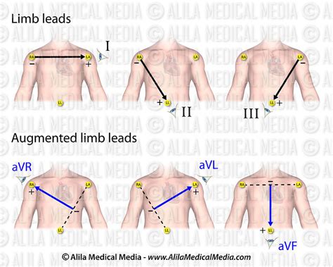 Alila Medical Media Hypercalcemia And Hypocalcemia Ecg Medical Illustration
