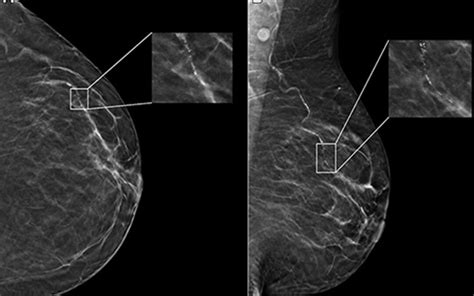 age race impact ai performance on digital mammograms ice