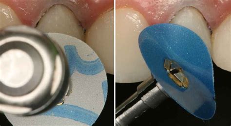 Best Composite Polishing System At Gillian Couey Blog