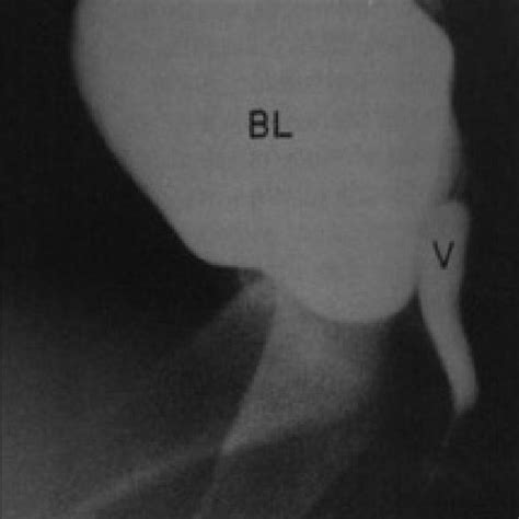 A Newborn Infant With Ambiguous Genitalia Malepseudohermaphroditis