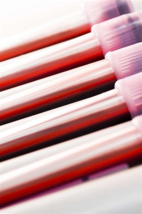 Epstein Barr Virus Test Procedure Results And Interpretation