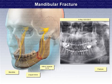 Mandibular Fracture Trialquest Inc