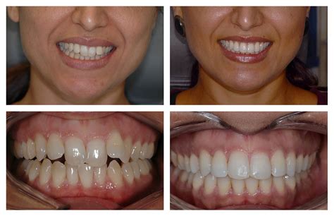 Surrey Damon Braces Treatment For Straight Teeth Mulberry Dental