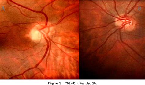 Figure 1 From Ocular Refractive And Biometric Characteristics In