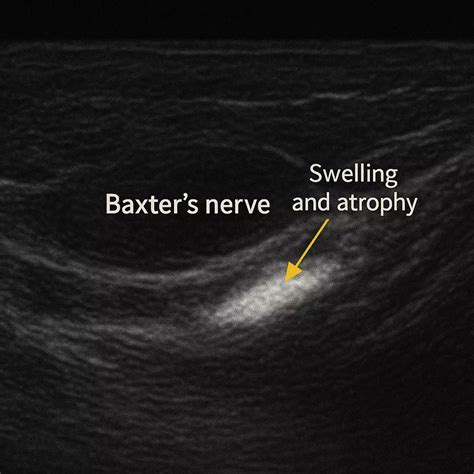 Baxters Nerve Entrapment Diagnosis Treatment And Recovery Uk