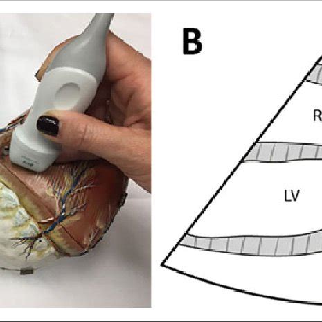 Subxiphoid Equivalent Modified Apical Four Chamber View A The Download Scientific Diagram