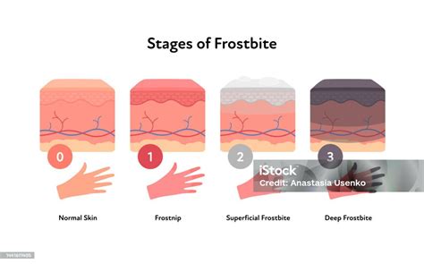 Levels Of Frostbite Types Of Frostbite Xxasm