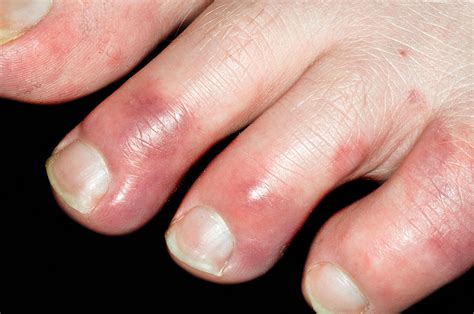 Chilblains Perniosis Symptoms And Treatment Healthdirect