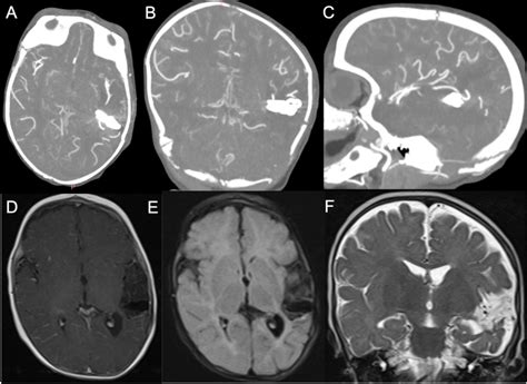 Brain Imaging On Follow Up A C One Month Follow Up Cta Revealed Download Scientific Diagram