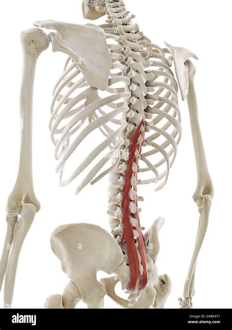 Multifidus Triangle Syndrome