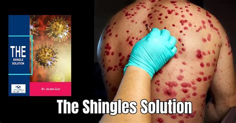 The Shingles Solution Review Julissa Clays Book That Works