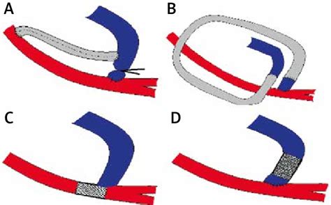 A The Pai Procedure Arterial Inflow Is Taken From The Larger Diameter