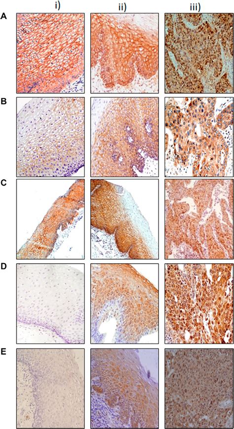 Protein Based Risk Model Predicts Esophageal Cancer Recurrence Oncotarget