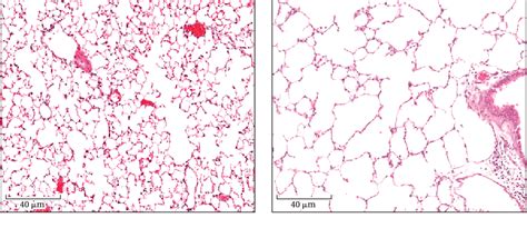 Figure 2 From Pulmonary Emphysema When More Is Less Semantic Scholar