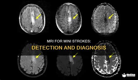 Mri For Mini Strokes Detection And Diagnosis Medshun