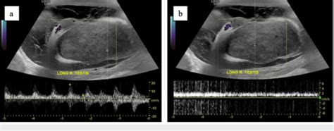 Spectral Doppler Ultrasound Of Right Testicle Demonstrating Normal
