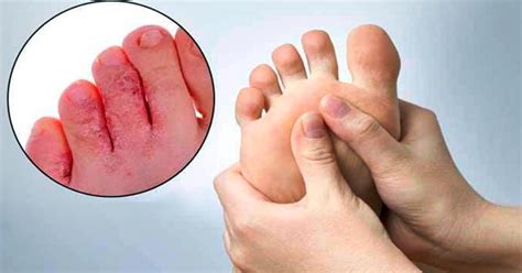 ფრჩხილისა და კანის სოკოს მორჩენაში ეს საშინაო საშუალებები ძალიან დამეხმარა