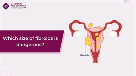 Which Size Of Fibroid Is Dangerous Dr Ibrahim Elrahman
