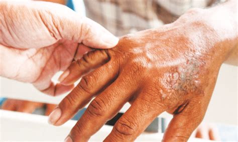 Namibia Records 28 Leprosy Cases Health Minister Calls For Continued