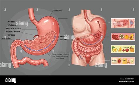 Human Stomach Medical Illustration Healthy Vs Gastritis Comparison With Enzymes Gastric