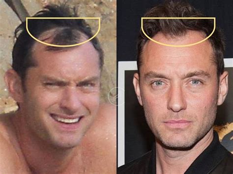 Jude Law Hair Transplant Hair Loss And Technical Analysis