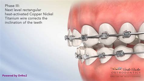 Braces Wire Lace At Madalyn Hartley Blog