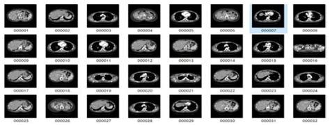 Using 2d Cnn With Taguchi Parametric Optimization For Lung Cancer