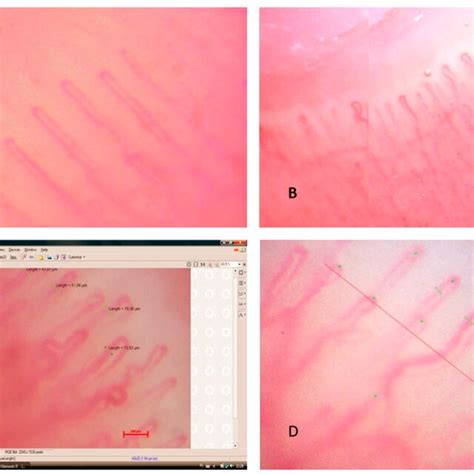 Capillaroscopic Pictures Of A Tortuous Capillaries B Meandering