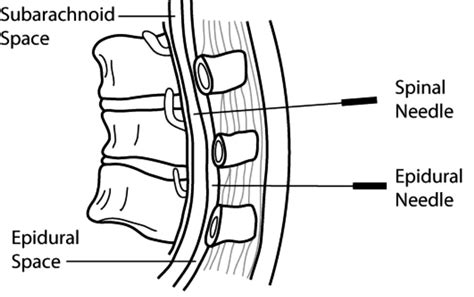 Intrathecal Vs Epidural Space