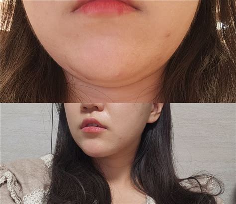 발품후기 얼굴지방흡입 이 강남언니 1등 성형수술and피부시술 정보앱