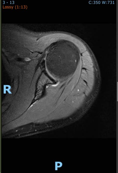 Mri Torn Labrum R Xrayporn