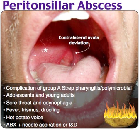 Deviated Uvula Sore Throat