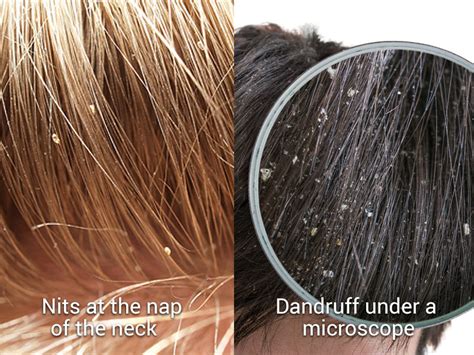 Lice Eggs Compared To Dandruff Lice Eggs Daftsex Hd