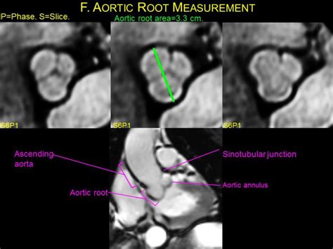 Aortaaorticrootmeasurementcardiacmriag3272017 Cardiac Mri