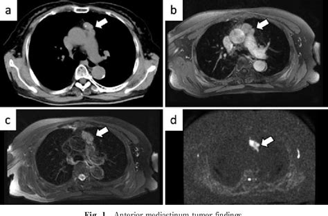 Figure 1 From Pleuro Pleural Communication After Trans Subxiphoid Robotic Thymectomy A Case
