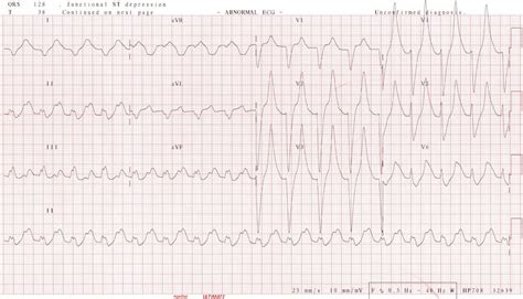 Hyperkalaemia Clinical Case • Litfl • Clinical Case