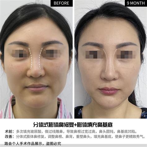 玻尿酸隆鼻变高不成反变宽，“阿凡达鼻”逃不了！ 知乎