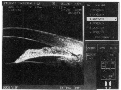 慢性闭角型青光眼前房角窄 眼科超声生物显微镜检查 医学