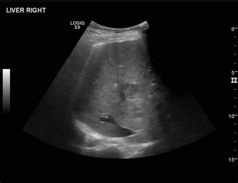 Cholangitis Ultrasound