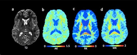 1 75 Isotropic Voxel Size Diffusion Kurtosis Imaging Panels B D Show Download Scientific