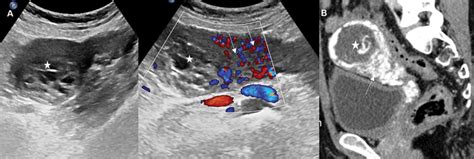 Multimodality Imaging In The Diagnosis And Staging Of Gestational