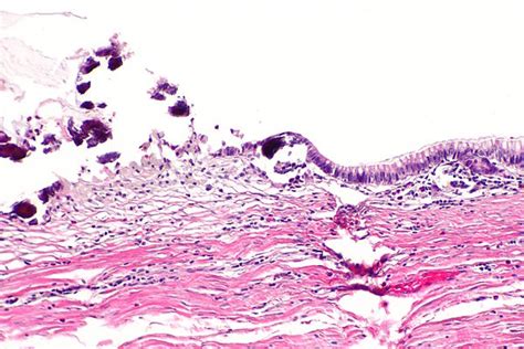 Mucinous Tumours Of The Appendix Libre Pathology