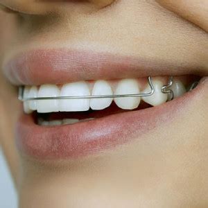 Straight Wire Braces Advanced Care For Confident Smiles
