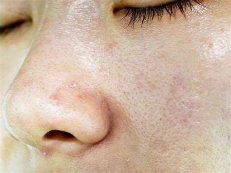 Get Rid Clogged Pores On Nose Squeeze Clean Remedies Causes Of Large Nose Pores American