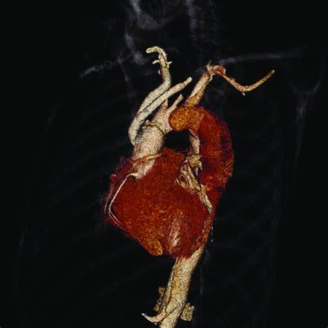 Computed Tomography Aortogram Reconstructed Image Of Aorta Prior To Download Scientific Diagram