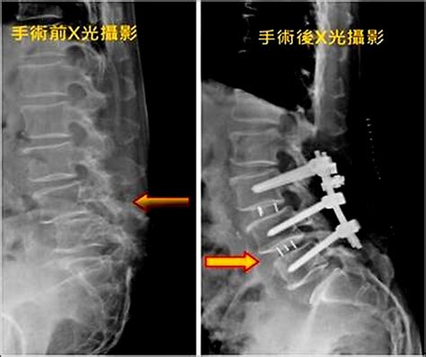 「腰椎滑脫症」壓迫神經 手術減壓固定 自由健康網