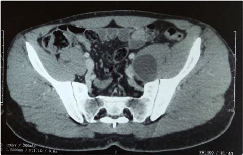 Abdominal Ct Scan Showing A Cystic Mass At The Expense Of The Left