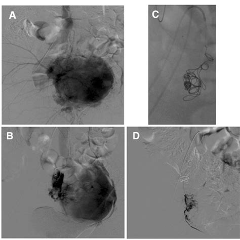 Diagnostic Arteriography From The Right Hypogastric Artery Shows A A
